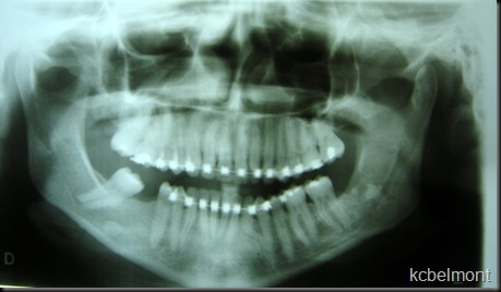 "Te vejo por dentro": Dilaceração radicular